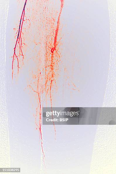 Angiogram Of Arteritis In Left Leg Inflammation Of Arterial Wall Due