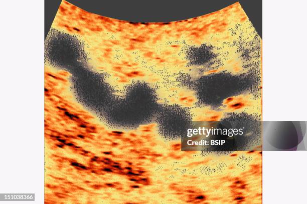 Dilation Of Pampiniform Photos And Premium High Res Pictures Getty Images