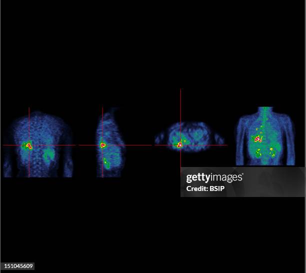 Lung Pet Scan Stock-Fotos und Bilder - Getty Images Lung Pet Scan Stock-Fotos und Bilder - Getty Images