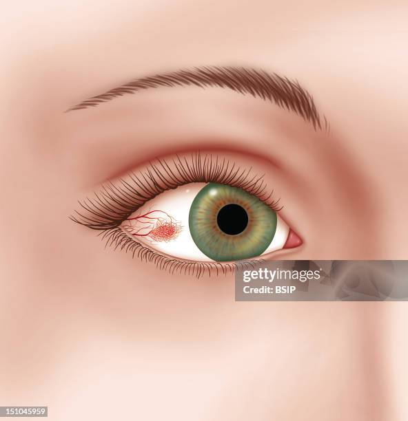 Episcleritis Photos And Premium High Res Pictures Getty Images