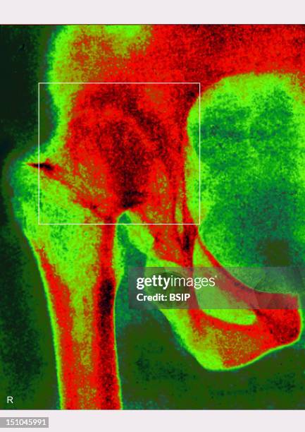 Arthritis Of The Hip X Ray Photos And Premium High Res Pictures Getty Images