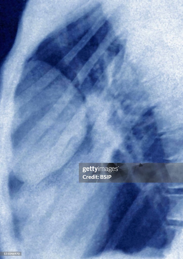 Mediastinal Dermoid Cyst Located In The Rib Cage Saggital Thoracic X Nachrichtenfoto Getty