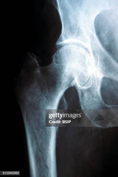Hip Fracture X Ray Photos And Premium High Res Pictures Getty Images