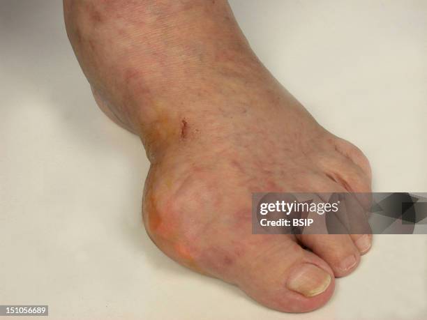 13 Tophus Stock Photos, High-Res Pictures, and Images - Getty Images 13 Tophus Stock Photos, High-Res Pictures, and Images - Getty Images