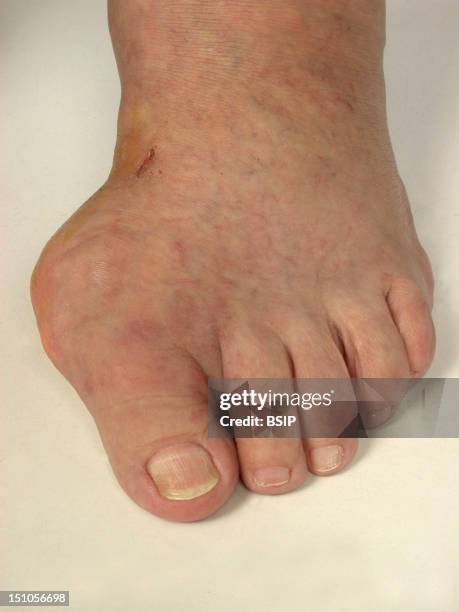 13 Tophus Stock Photos, High-Res Pictures, and Images - Getty Images 13 Tophus Stock Photos, High-Res Pictures, and Images - Getty Images