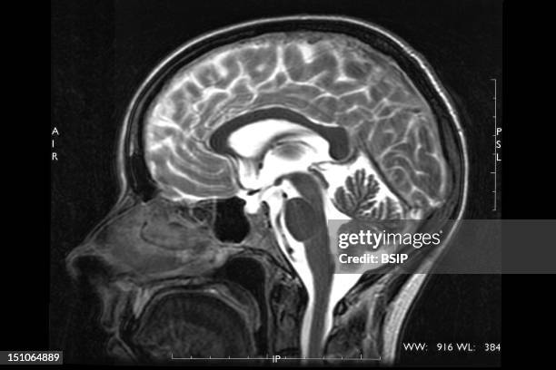Sagittal View Of Brain Mri