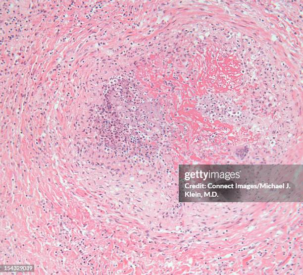 Buergers Disease Photos And Premium High Res Pictures Getty Images