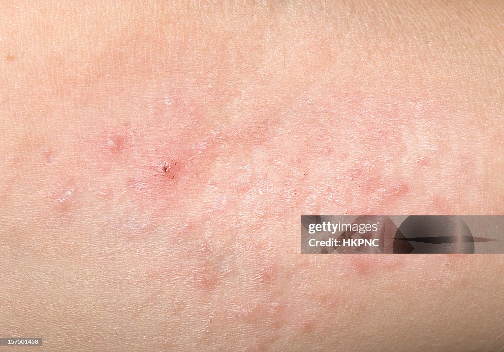 Red Bumps On Skin