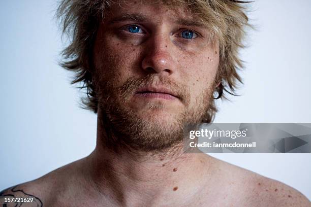 Blue Nevus Photos And Premium High Res Pictures Getty Images
