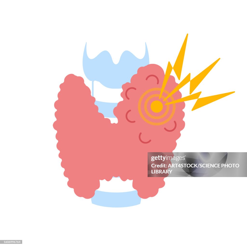 Enlarged Thyroid Gland Illustration High Res Vector Graphic Getty Images