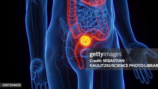 Rectal Cancer Illustration High Res Vector Graphic Getty Images
