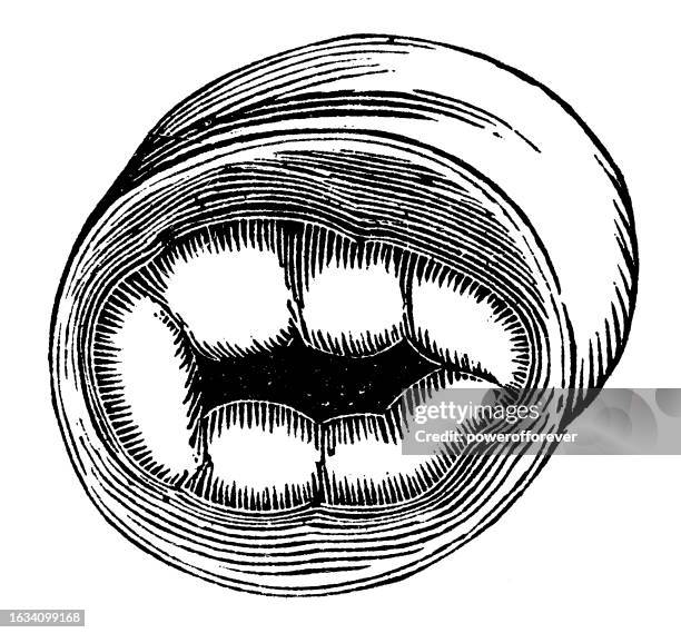 Rectal Prolapse Photos And Premium High Res Pictures Getty Images