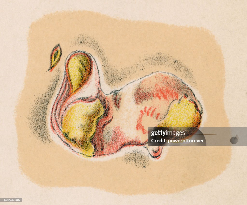 Medical Illustration Of A Gumma On The Bone Of A Person With Syphilis 19th Century High Res