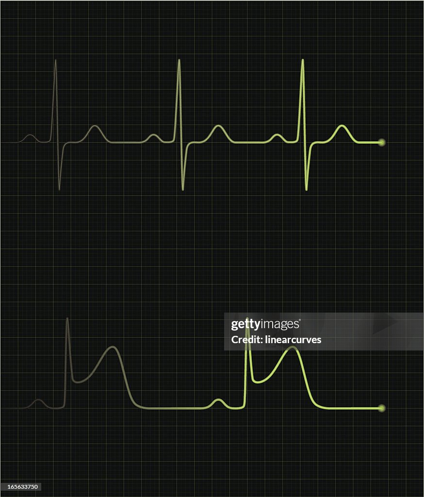 Normal Vs Abnormal Ecg