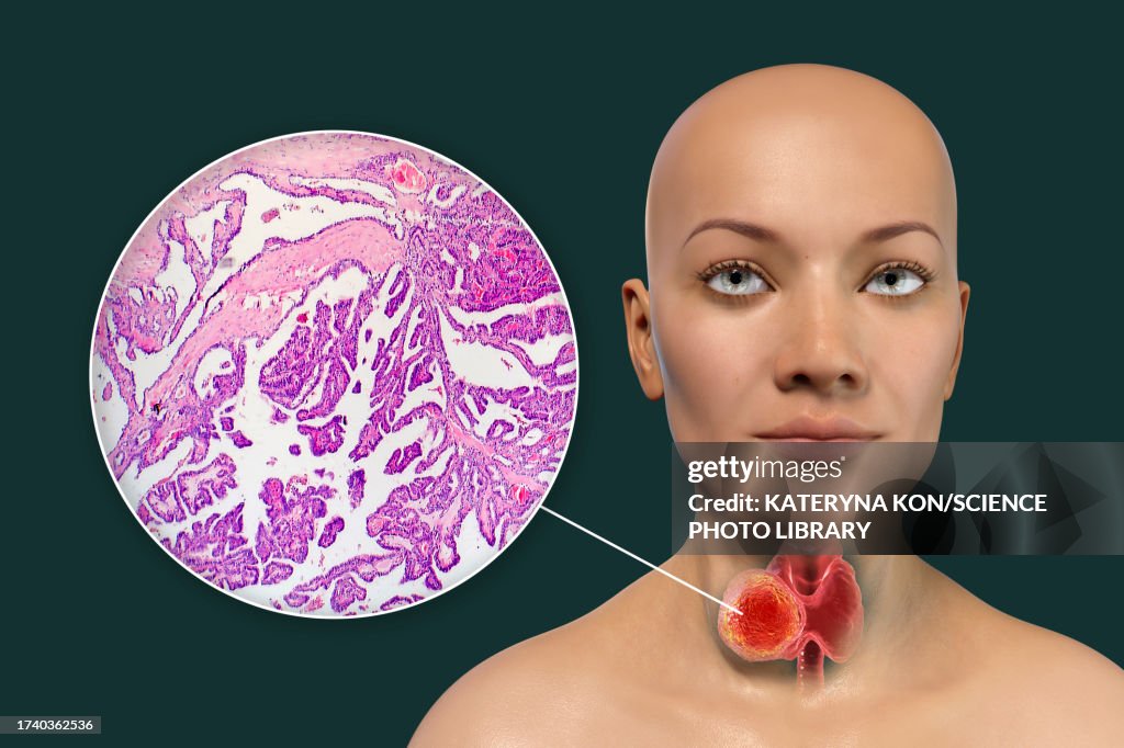 Woman With Thyroid Cancer Illustration High Res Vector Graphic Getty Images