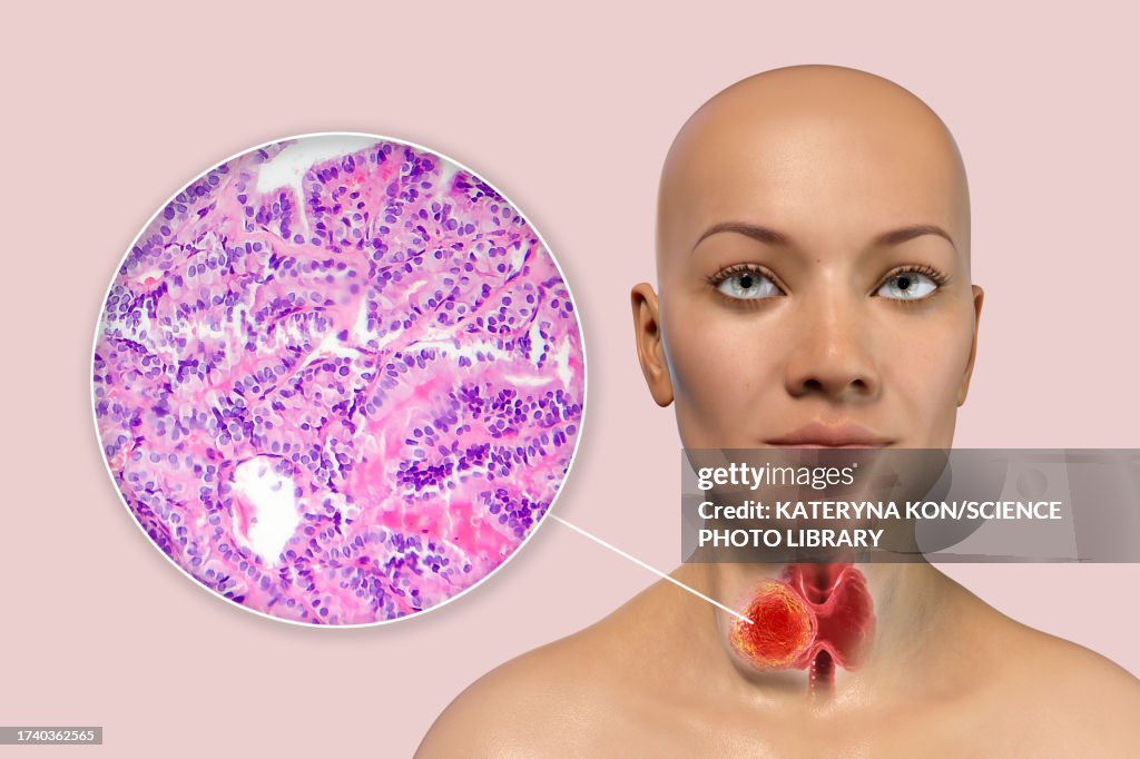 Woman With Thyroid Cancer Illustration High Res Vector Graphic Getty Images