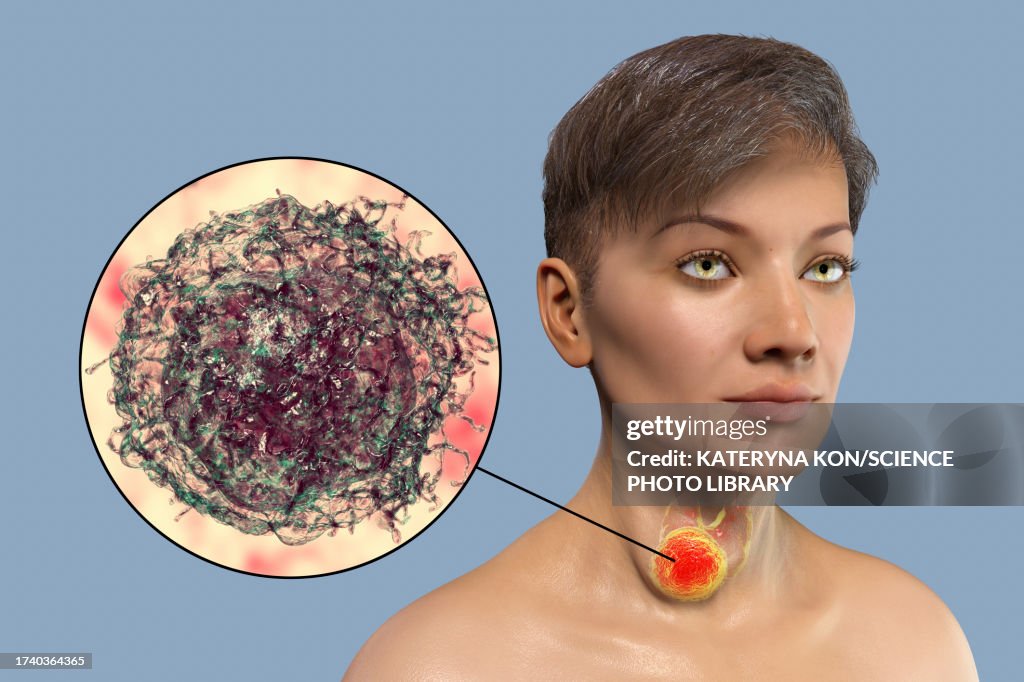 Woman With Thyroid Cancer Illustration High Res Vector Graphic Getty Images