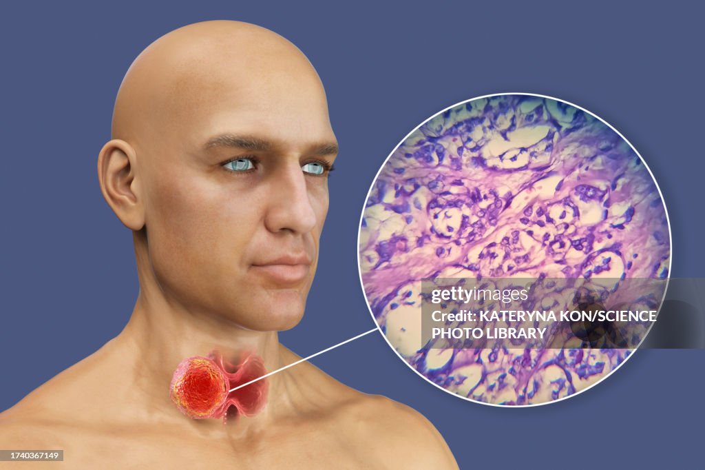 Man With Thyroid Cancer Illustration High Res Vector Graphic Getty Images