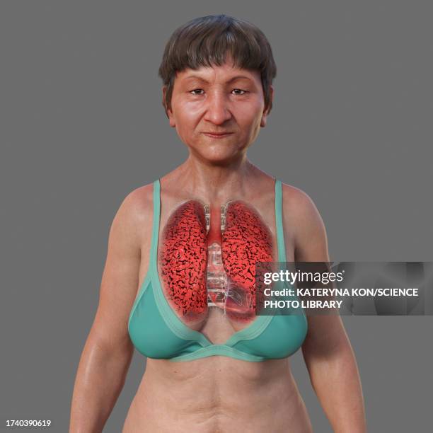 Smokers Lungs Illustration High Res Vector Graphic Getty Images