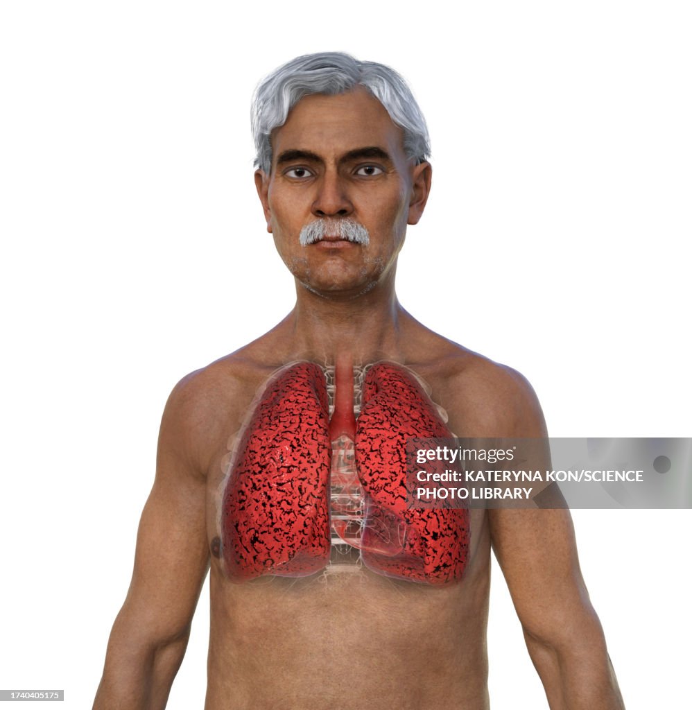 Smokers Lungs Illustration High Res Vector Graphic Getty Images