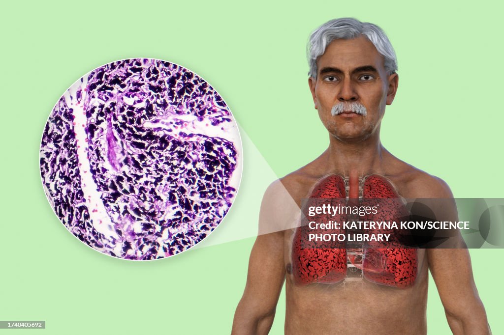 Smokers Lungs Illustration High Res Vector Graphic Getty Images
