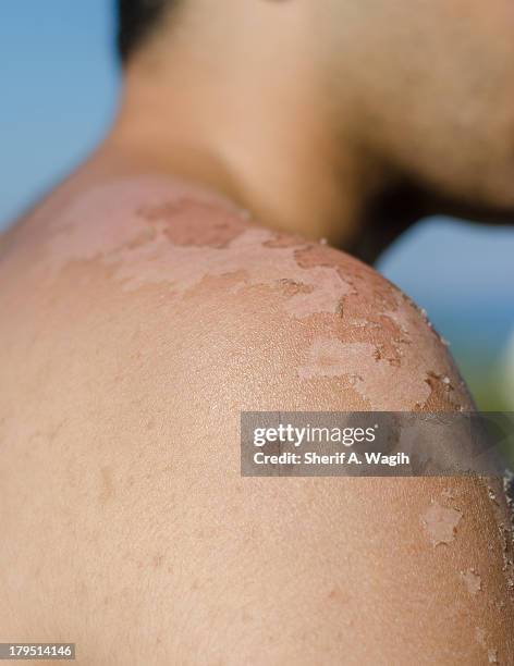 Sunburn Shoulder Photos And Premium High Res Pictures Getty Images