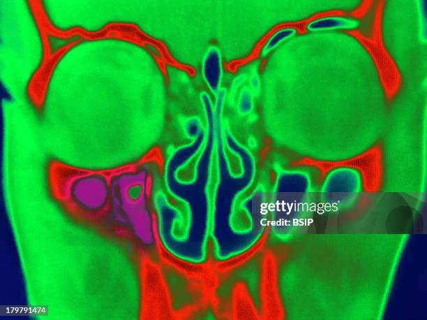 Nasal Polyps Xray Photos And Premium High Res Pictures Getty Images