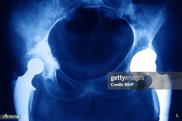 Arthritis Of The Hip X Ray Fotografías E Imágenes De Stock Getty Images