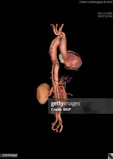Aortic Dissection Fotografías E Imágenes De Stock Getty Images