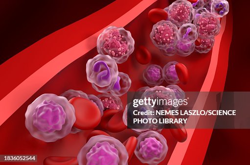 Acute Lymphoblastic Leukemia Pathophysiology Schematic Diagr