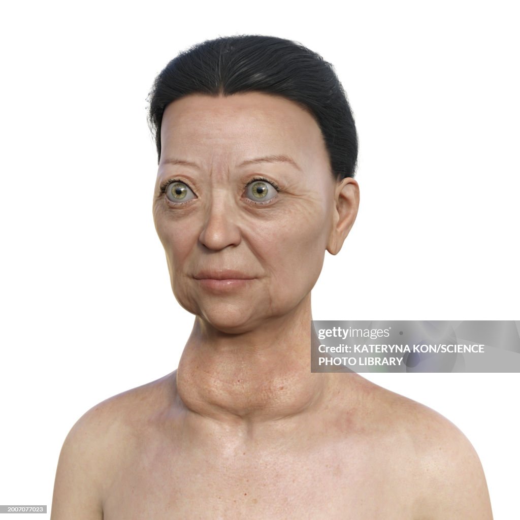 Woman With Graves Disease Illustration High Res Vector Graphic Getty Images