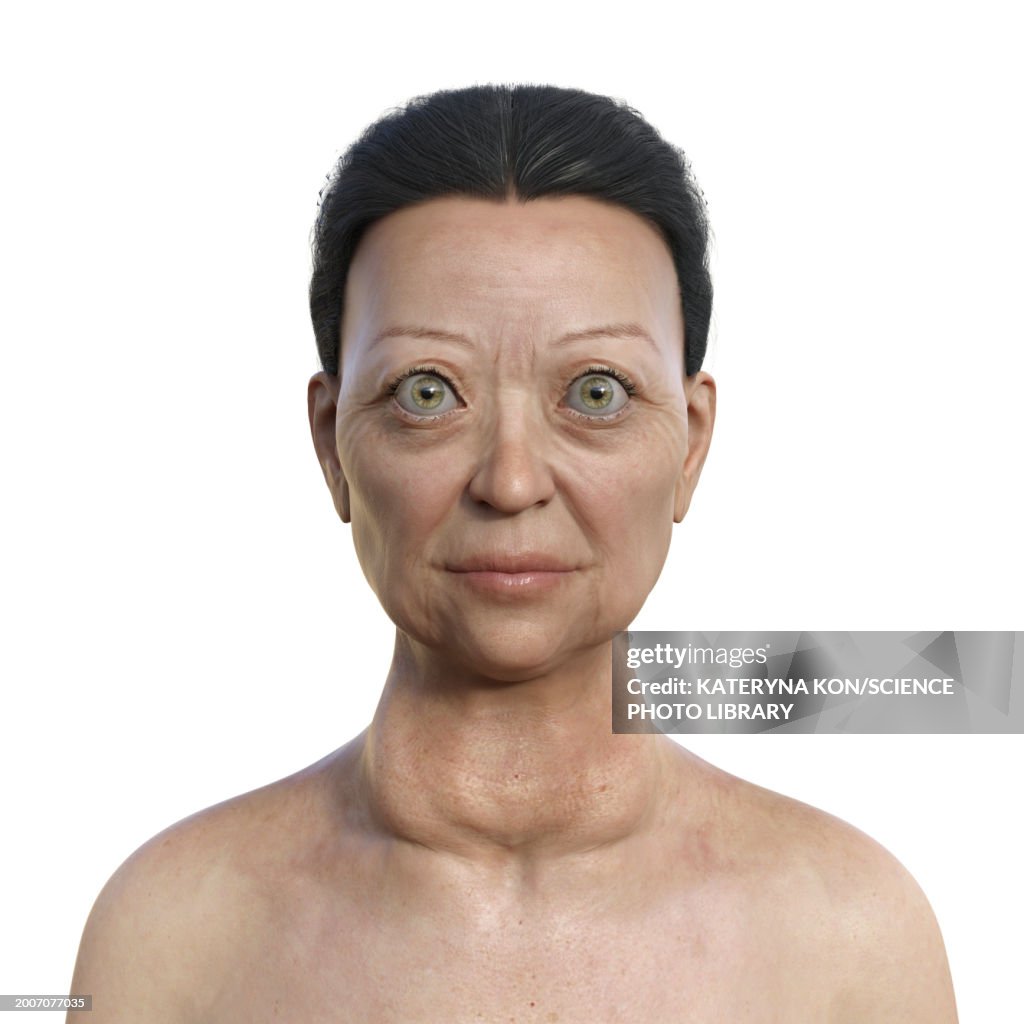 Woman With Graves Disease Illustration High Res Vector Graphic Getty