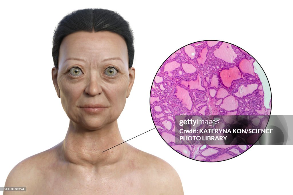 Woman With Graves Disease Illustration High Res Vector Graphic Getty