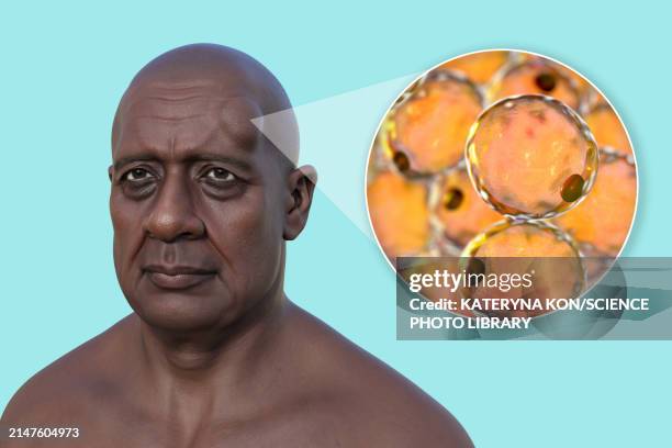 Lipoma Images Photos And Premium High Res Pictures Getty Images