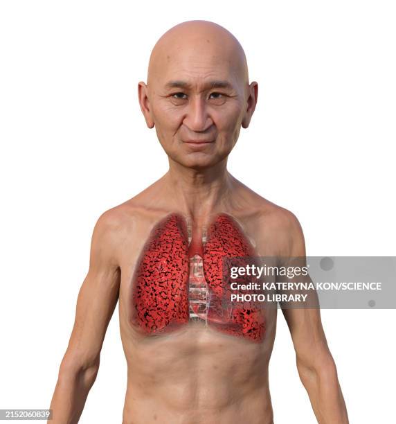 Man With Smokers Lungs Illustration High Res Vector Graphic Getty Images