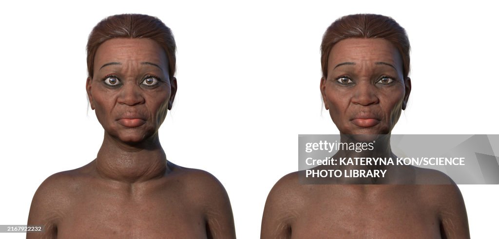 Woman With Graves Disease Illustration High Res Vector Graphic Getty