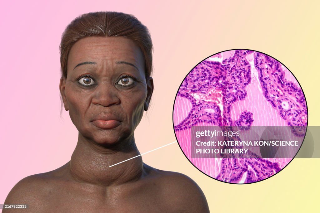 Woman With Graves Disease Illustration High Res Vector Graphic Getty