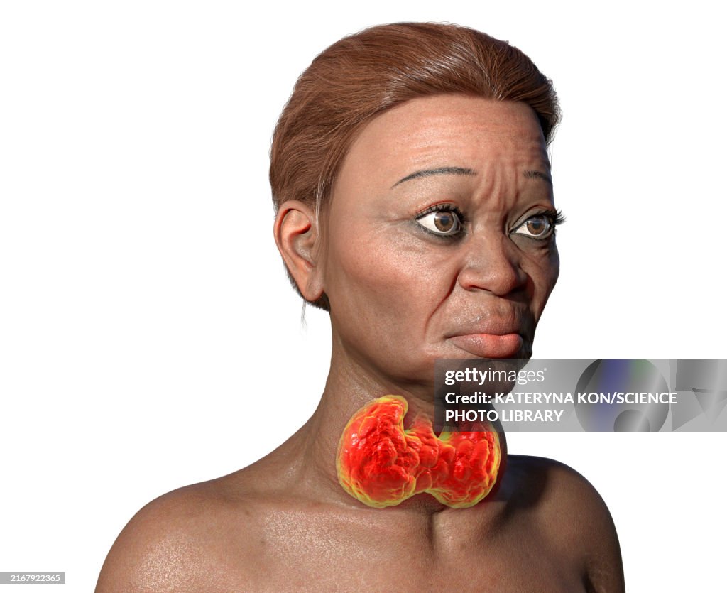 Woman With Graves Disease Illustration High Res Vector Graphic Getty