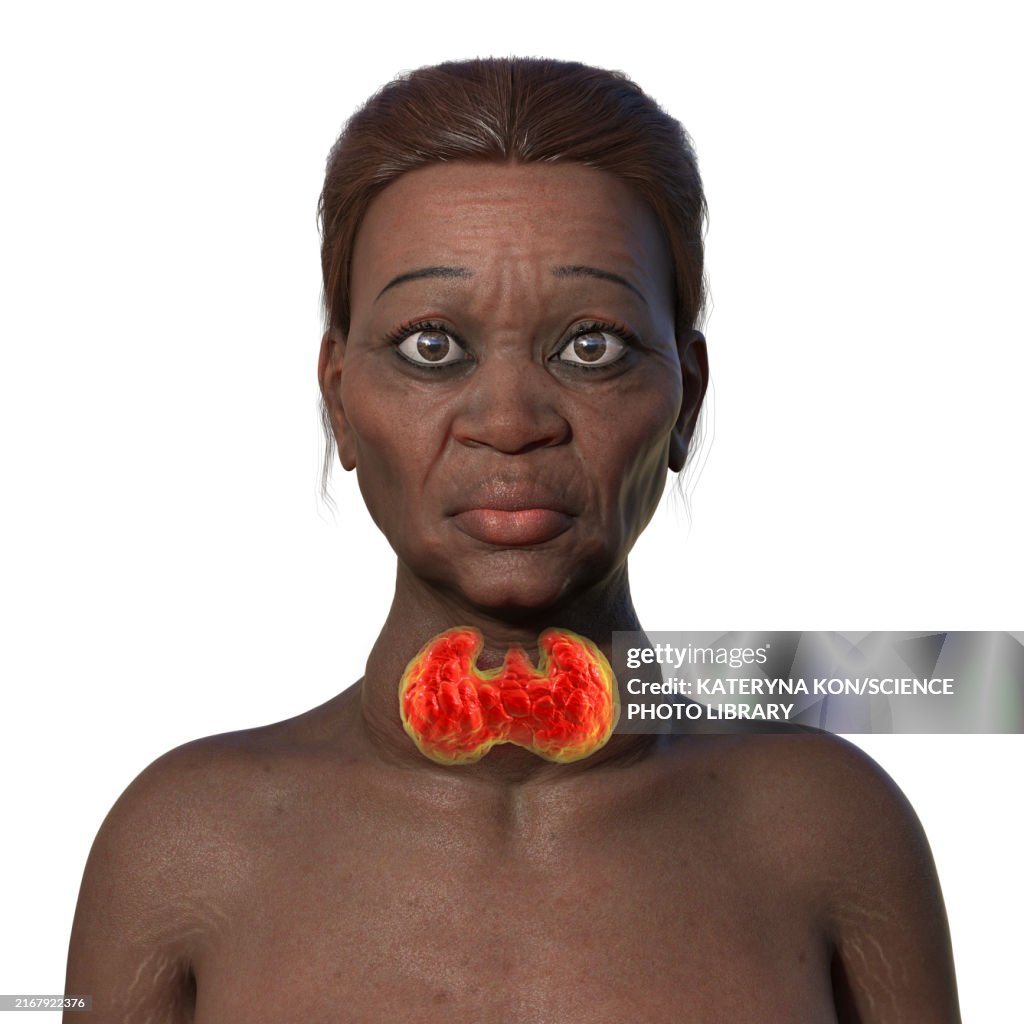 Woman With Graves Disease Illustration High Res Vector Graphic Getty