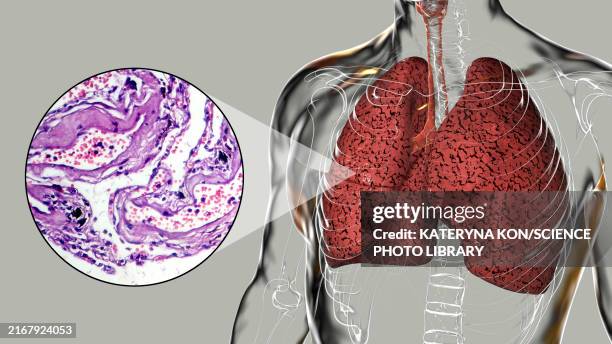 Smokers Lungs Illustration High Res Vector Graphic Getty Images