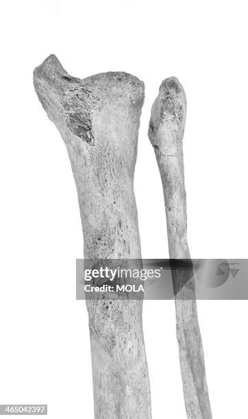 Spiral Fracture Photos And Premium High Res Pictures Getty Images