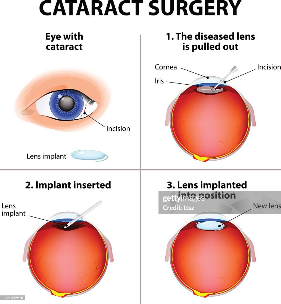 Cataract Surgery High Res Vector Graphic Getty Images