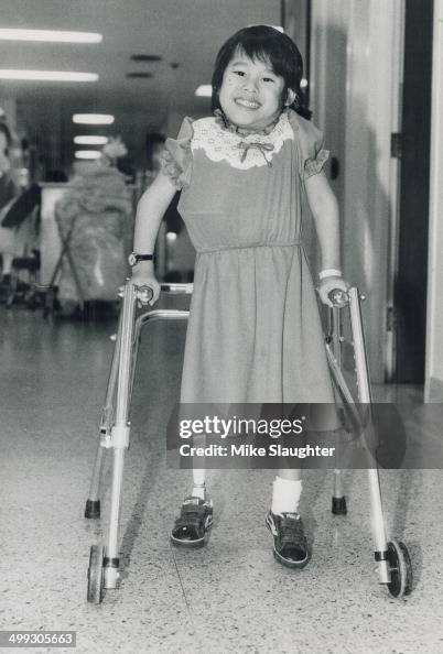 Getting Stronger Win Htut 5 Separated From Her Siamese Twin News Photo Getty Images