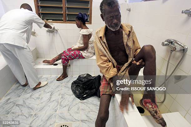 49 Buruli Ulcer Photos & High Res Pictures - Getty Images 49 Buruli Ulcer Photos & High Res Pictures - Getty Images