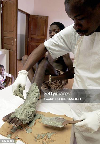 49 Buruli Ulcer Photos & High Res Pictures - Getty Images 49 Buruli Ulcer Photos & High Res Pictures - Getty Images