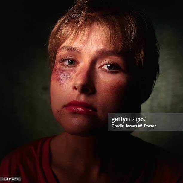 Bruised Face Woman Fotografías E Imágenes De Stock Getty Images