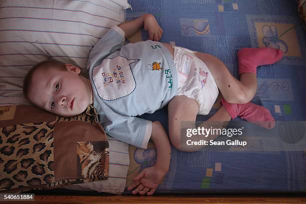Birth Defects Photos And Premium High Res Pictures Getty Images