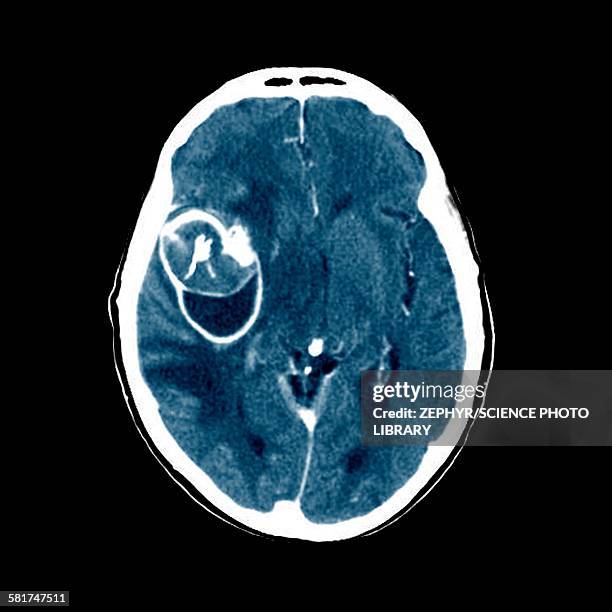 Brain Aneurysm Photos and Premium High Res Pictures - Getty Images Brain Aneurysm Photos and Premium High Res Pictures - Getty Images