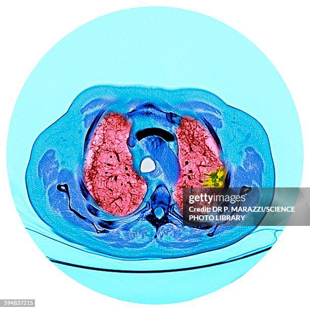 726 Lung Ct Scan Stock Photos, High-Res Pictures, and Images - Getty Images 726 Lung Ct Scan Stock Photos, High-Res Pictures, and Images - Getty Images