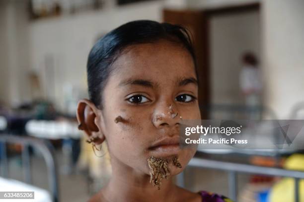 Tree Man Syndrome A Rare Genetic Hereditary Skin Disorder Photos Et